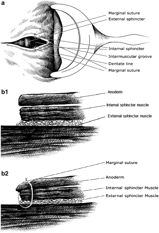 Evaluation of Healing and Complications After Lateral Internal ...