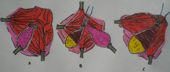 Stapled hemorrhoidopexy versus Milligan–Morgan hemorrhoidectomy: a ...