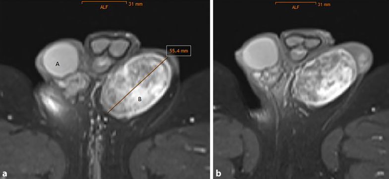 Incidental resection of a scrotal aggressive angiomyxoma mimicking a ...