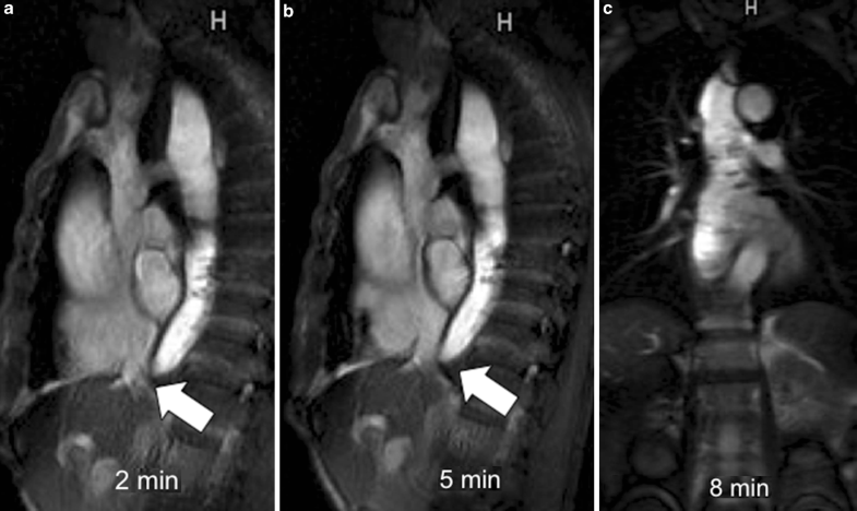 Swallowing MRI for GERD—diagnosis and treatment monitoring | SpringerLink