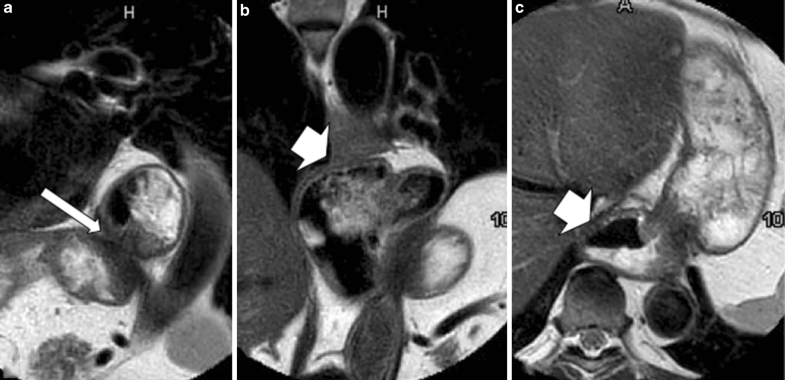Swallowing MRI for GERD—diagnosis and treatment monitoring | SpringerLink