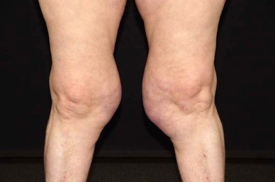 Juxta-articular adiposis dolorosa (Dercum’s disease type IV): report of ...