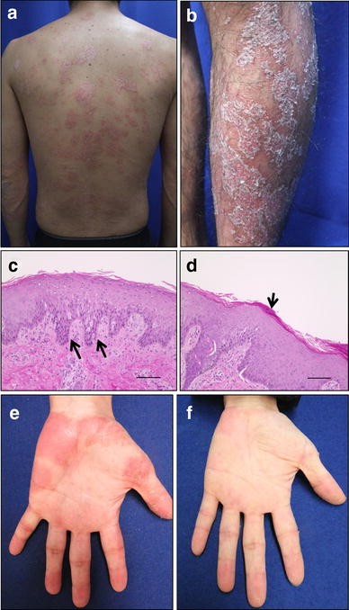 Psoriasis triggered by infliximab in a patient with Behçet’s disease ...