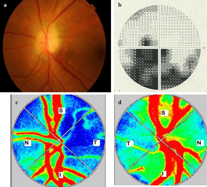 Laser speckle flowgraphy for differentiating between nonarteritic ...