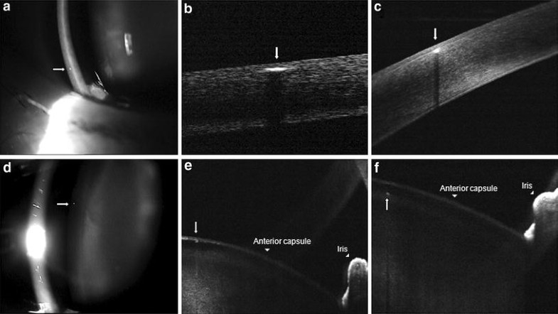 Optical coherence tomographic findings of crystal deposits in the lens ...