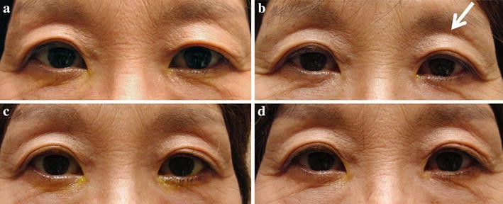 Incidence of deepening of the upper eyelid sulcus on treatment with a ...