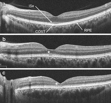 Occult macular dystrophy | SpringerLink