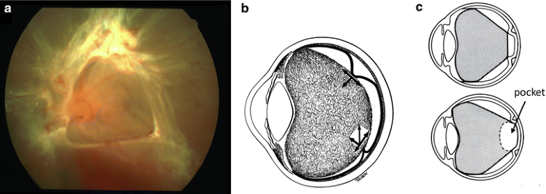 Vitreous anatomy and the vitreomacular correlation | SpringerLink