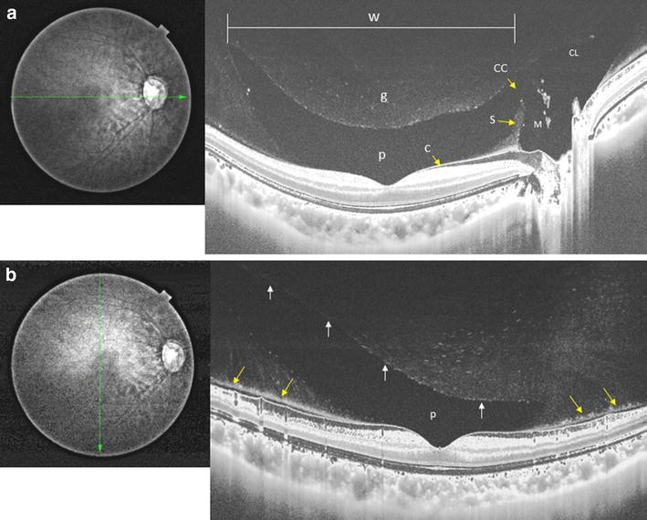 Vitreous anatomy and the vitreomacular correlation | SpringerLink