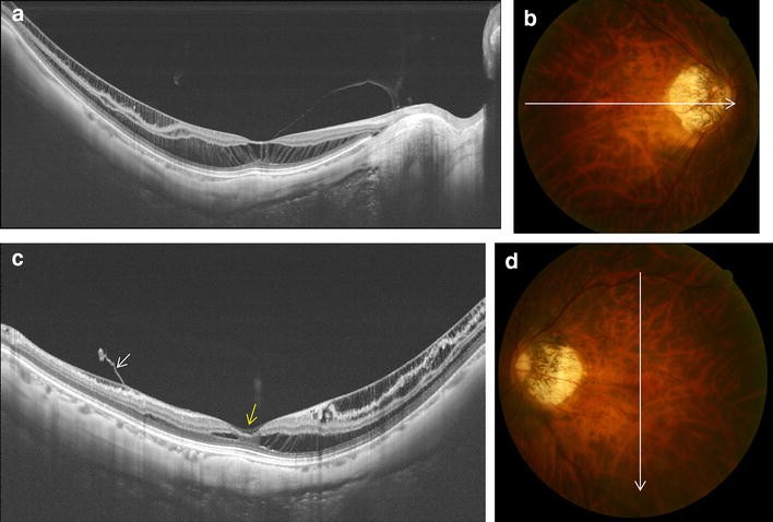 Vitreous anatomy and the vitreomacular correlation | SpringerLink