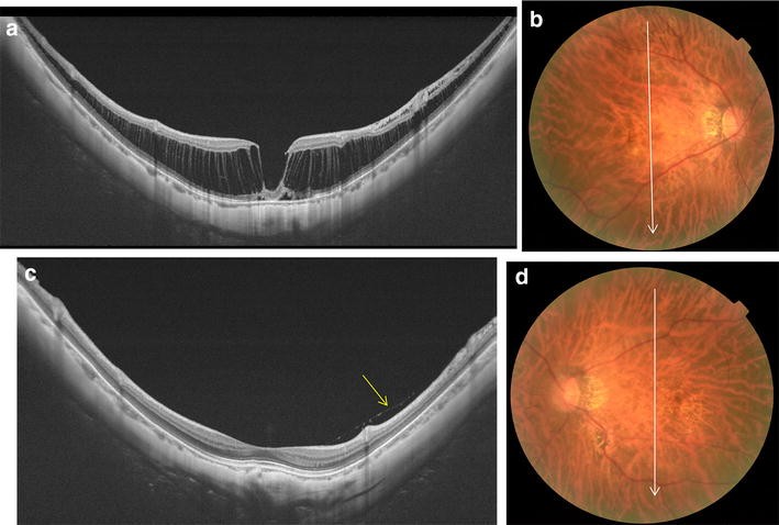 Vitreous anatomy and the vitreomacular correlation | SpringerLink