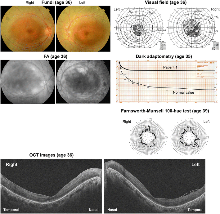 New truncation mutation of the NR2E3 gene in a Japanese patient with ...