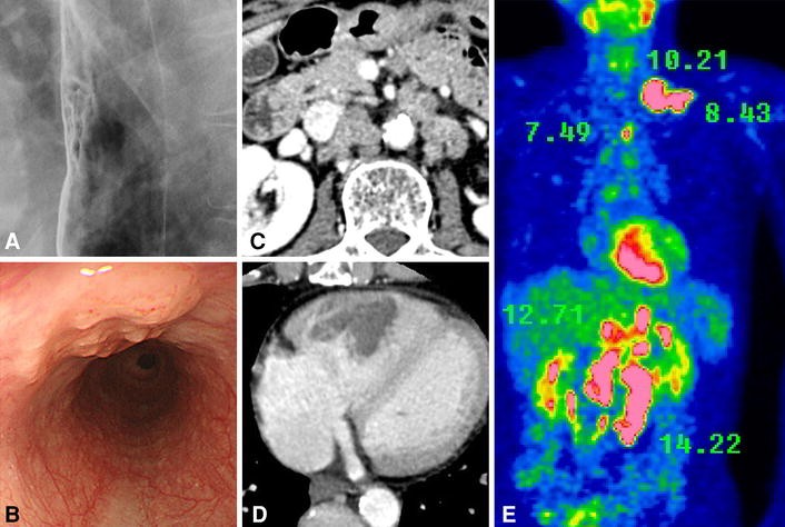 A case report of pulmonary tumor thrombotic microangiopathy (PTTM ...