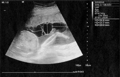 Placental multiple chorionic cysts in maternal scleroderma | SpringerLink