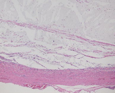 Appendiceal mucocele and peritoneal inclusion cyst mimicking right ...