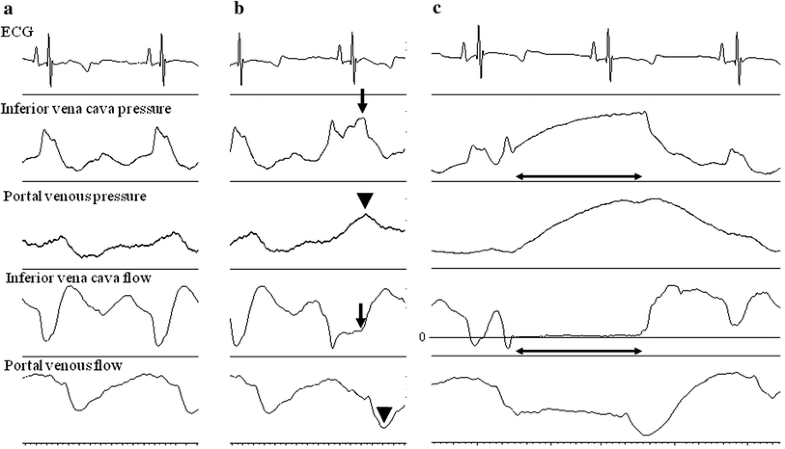 Experimental evaluation of portal venous pulsatile flow synchronized ...