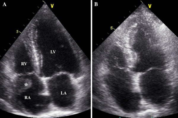 Primary cardiac lymphoma diagnosed by endomyocardial biopsy using ...