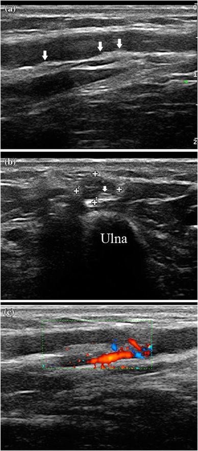 Ulnar nerve sonography in leprosy neuropathy | SpringerLink