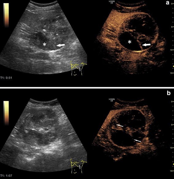 Splenic cystic lymphangioma with atypical ultrasound findings ...