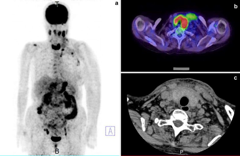 Ultrasound findings of diffuse metastasis of gastric signet-ring-cell ...