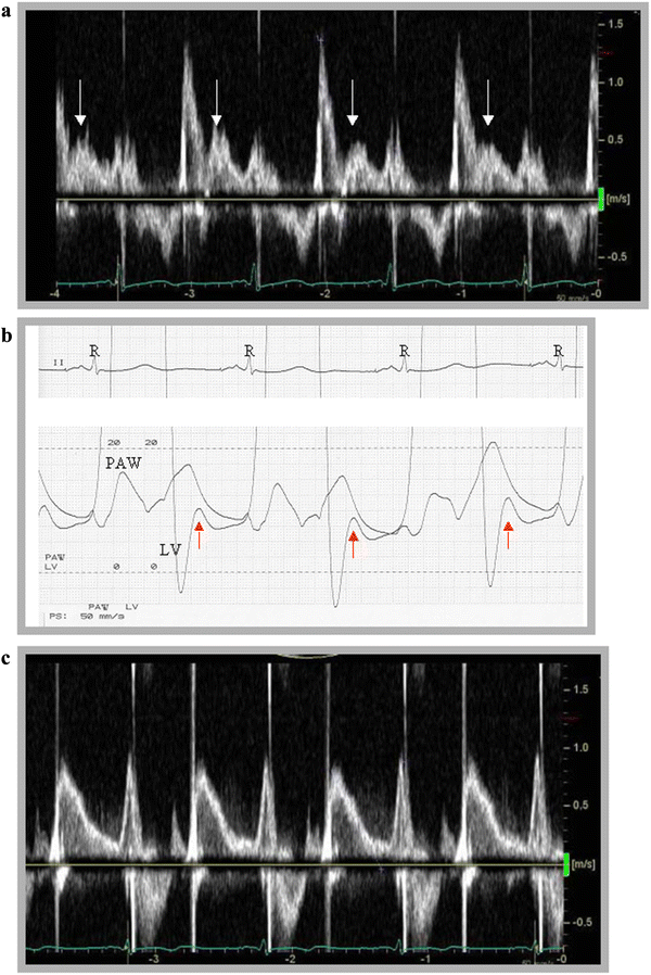 Triphasic mitral inflow pattern associated with hemodynamic ...
