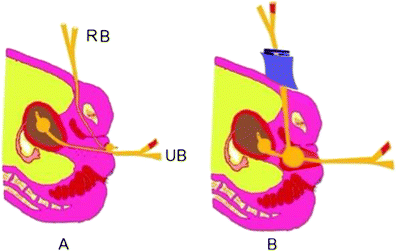 Cryptomenorrhea with cervicovaginal aplasia: endoscopic transfundal ...