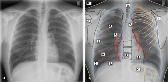 Röntgenuntersuchung des Thorax | SpringerLink