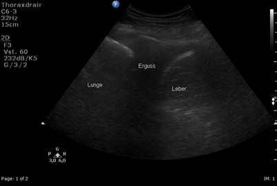 Transthorakale und endobronchiale Thoraxsonographie beim ...