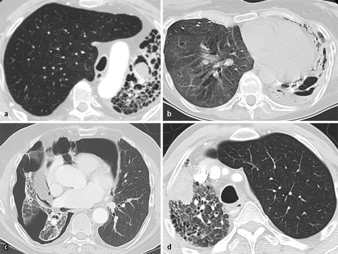 Indikationen und Ergebnisse der Lungentransplantation bei idiopathischer Lungenfibrose ...