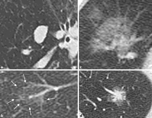 Radiologische Abklärung pulmonaler Rundherde | SpringerLink