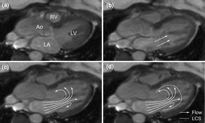 Vortex Ring Formation in the Left Ventricle of the Heart: Analysis by ...