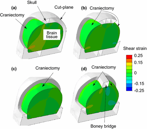 Modelling of Brain Deformation After Decompressive Craniectomy ...