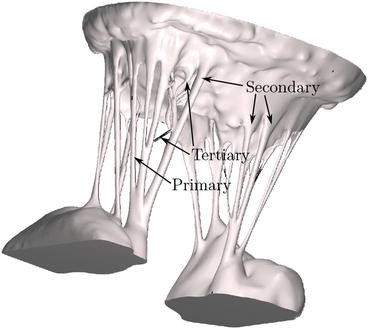 Fluid-Structure Interaction Analysis of Ruptured Mitral Chordae ...