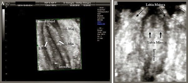 2D and 3D Ultrasound Examination of Labia Minora | SpringerLink
