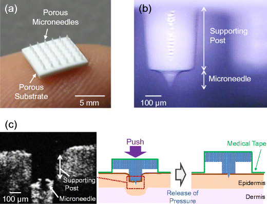 An array of porous microneedles for transdermal monitoring of ...