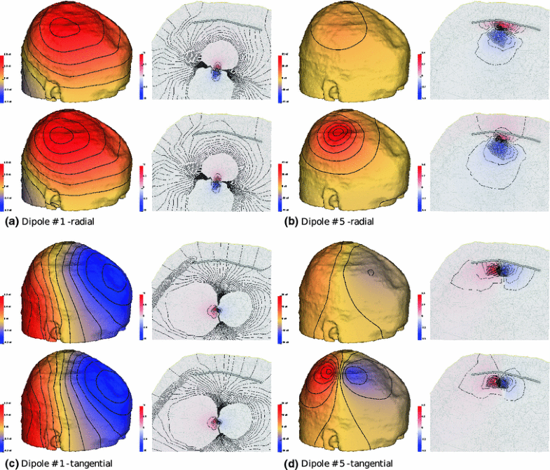 Influence of a Silastic ECoG Grid on EEG/ECoG Based Source Analysis ...