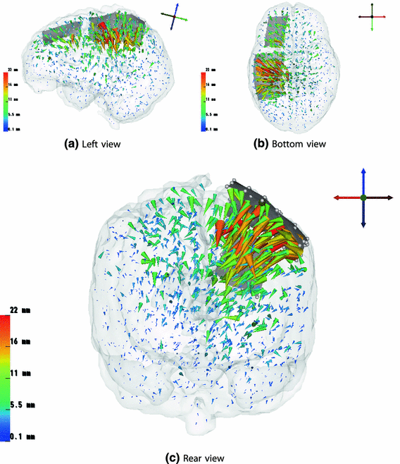 Influence of a Silastic ECoG Grid on EEG/ECoG Based Source Analysis ...