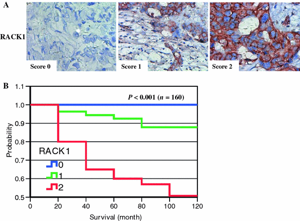 RACK1 promotes breast carcinoma proliferation and invasion/metastasis ...