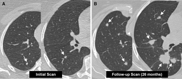 Clinical significance of noncalcified lung nodules in patients with ...