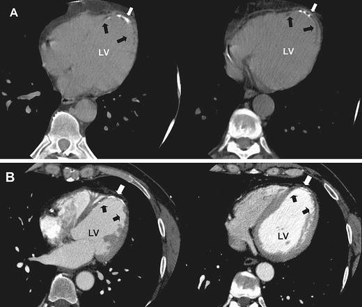 Myocardial calcification and subendocardial fatty replacement of the ...