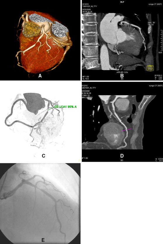 Comparison of dual-source ct coronary angiography and conventional ...