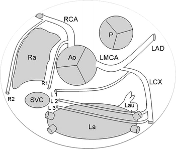 Arterial supply of the sinoatrial node: a CT coronary angiographic ...