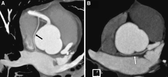 Arterial supply of the sinoatrial node: a CT coronary angiographic ...