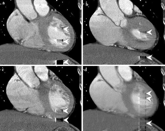 Partial ring artifact on cardiac CT: image presentation and clinical ...