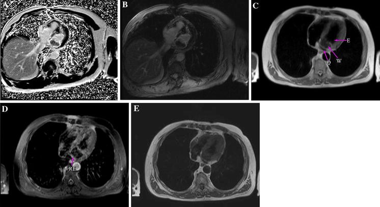Liquefaction necrosis of mitral annular calcification (LNMAC): review ...