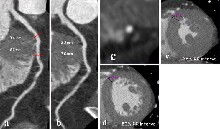 Systolic luminal narrowing and morphologic characteristics of ...