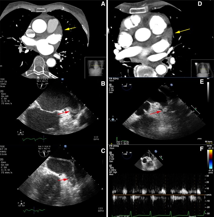 Double-contrast, single-phase computed tomography angiography for ...