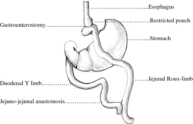 Gastrojejunal Stricture After Gastric Bypass and Efficacy of Endoscopic ...