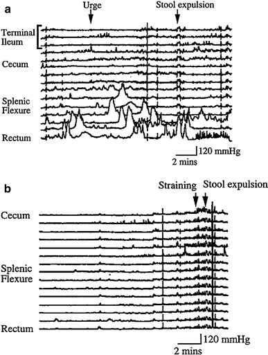 The Physiology of Human Defecation | SpringerLink