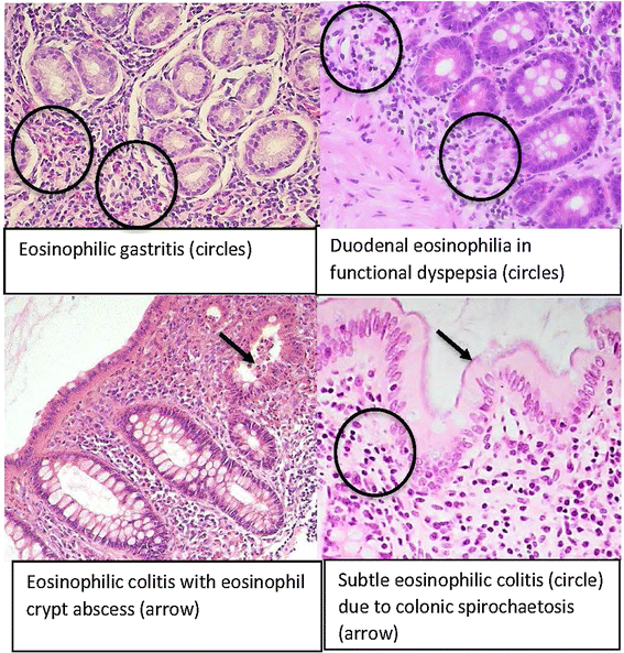 Established and Emerging Eosinophilic Gastrointestinal Diseases (EGIDs ...